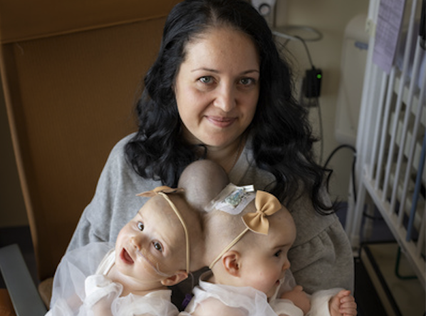 Conjoined twins get life-saving care at UC Davis Health