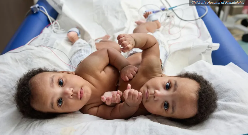 Conjoined Twins - Fetal Health Foundation